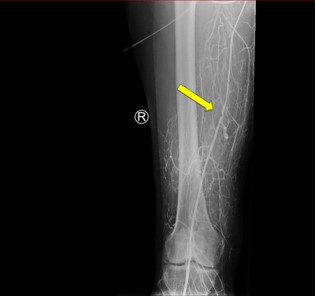 Abstract 3 Treatment of acute limb ischemia in an Impella CP patient