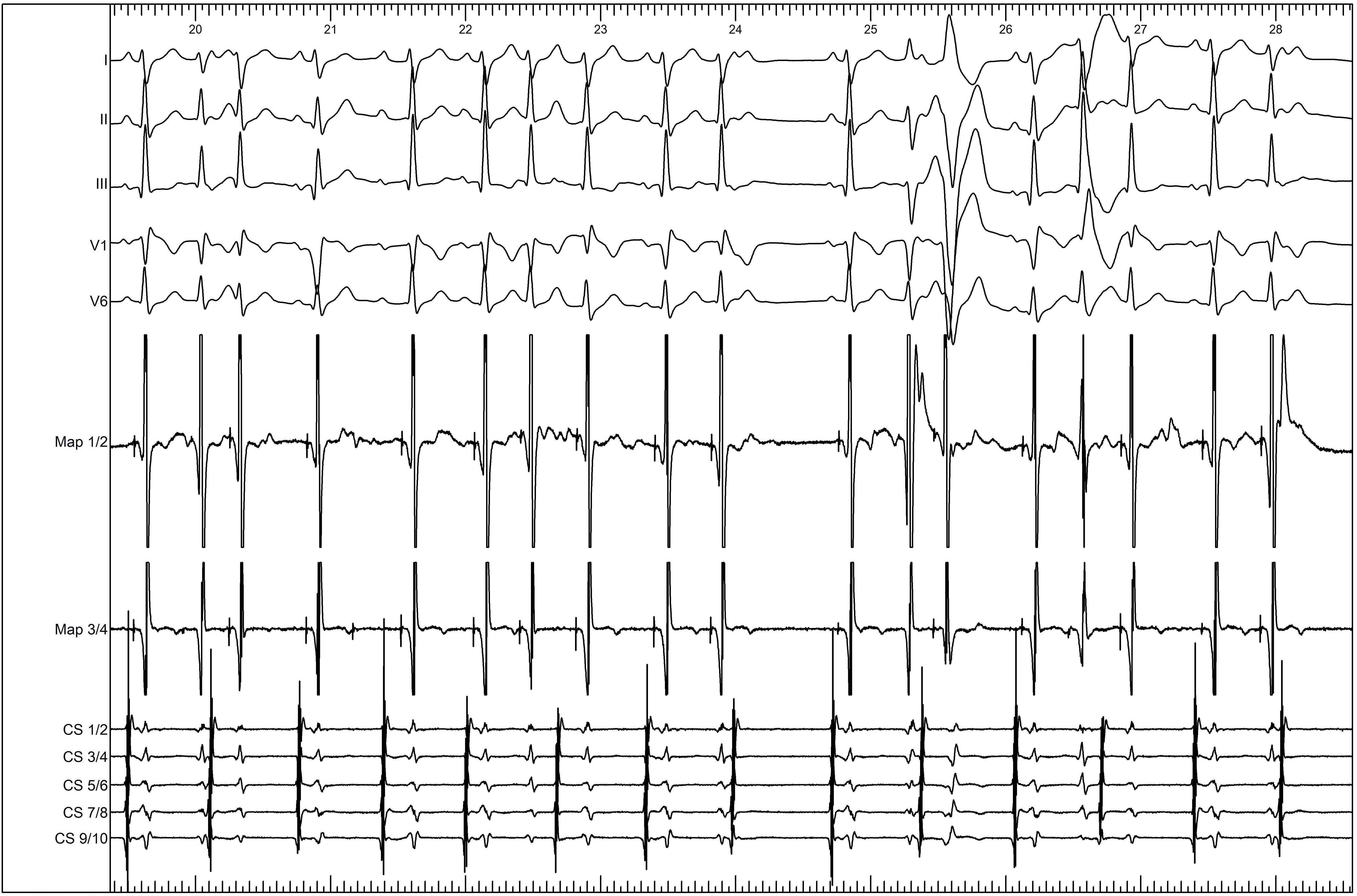 Abstract 157 Young woman with idiopathic ventricular fibrillation and ...